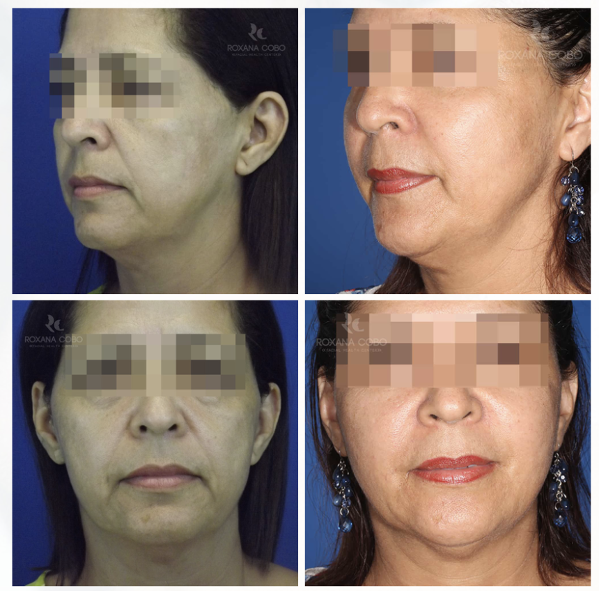 Lifting De Tercio Medio En Cali - Rejuvenecimiento Facial - Roxana Cobo